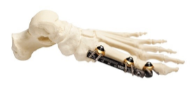 OrthoPediatrics | Mini Rails | Fixação externa