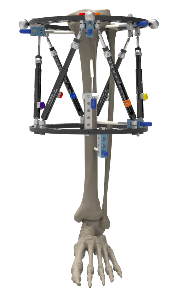 ORTHEX Small Bone Circular Fixator - OrthoPediatrics