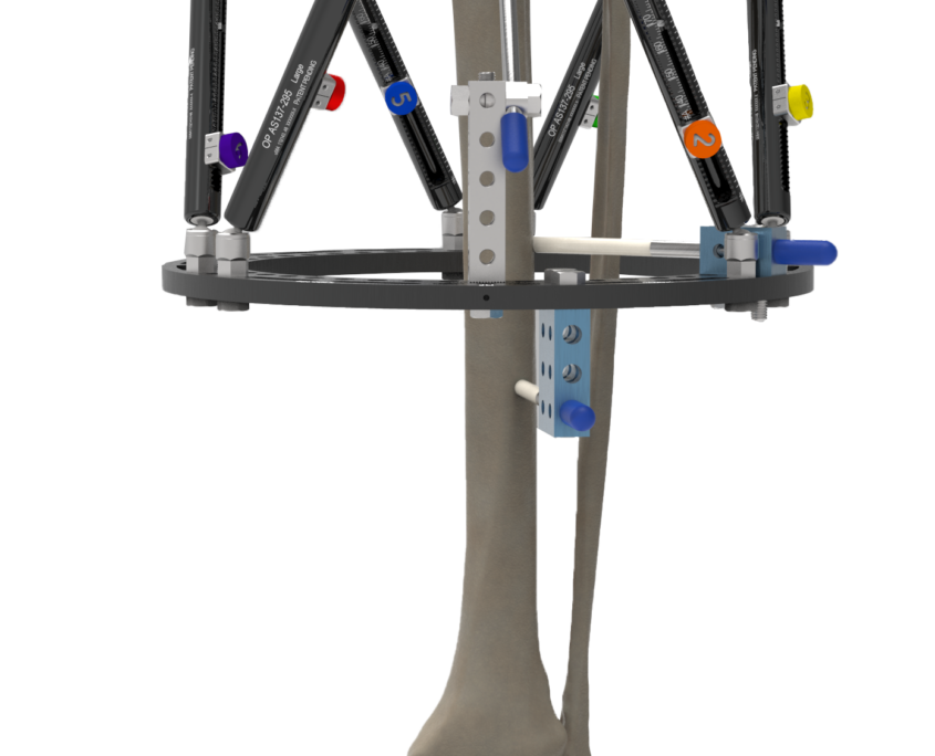 External Fixation - OrthoPediatrics