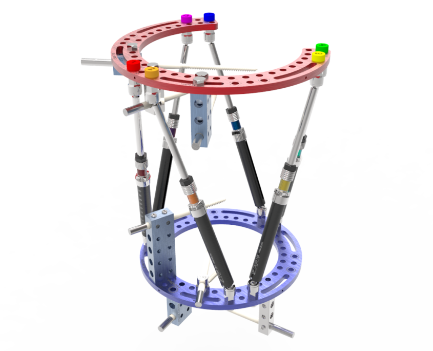 External Fixation - OrthoPediatrics