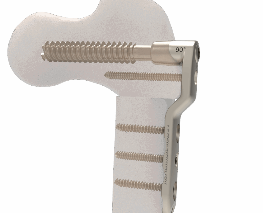 Deformity Correction - OrthoPediatrics